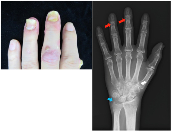 Treatment in Patients with Psoriatic Disease and Rheumatoid Arthritis ...