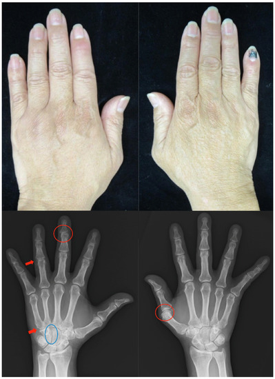 Treatment in Patients with Psoriatic Disease and Rheumatoid Arthritis ...