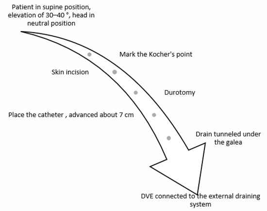 External Ventricular Drainage: A Practical Guide for Neuro-Anesthesiologists