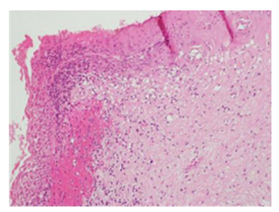 Rare Complication Post-Conization for Cervical Dysplasia: Rectovaginal ...