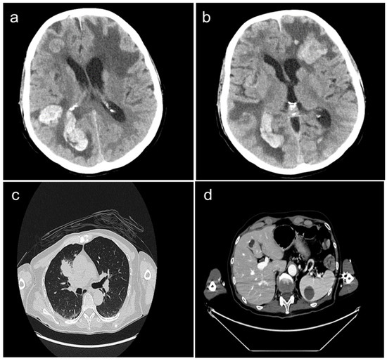 Evaluation of Potential Predictive Biomarkers for Defining Brain ...