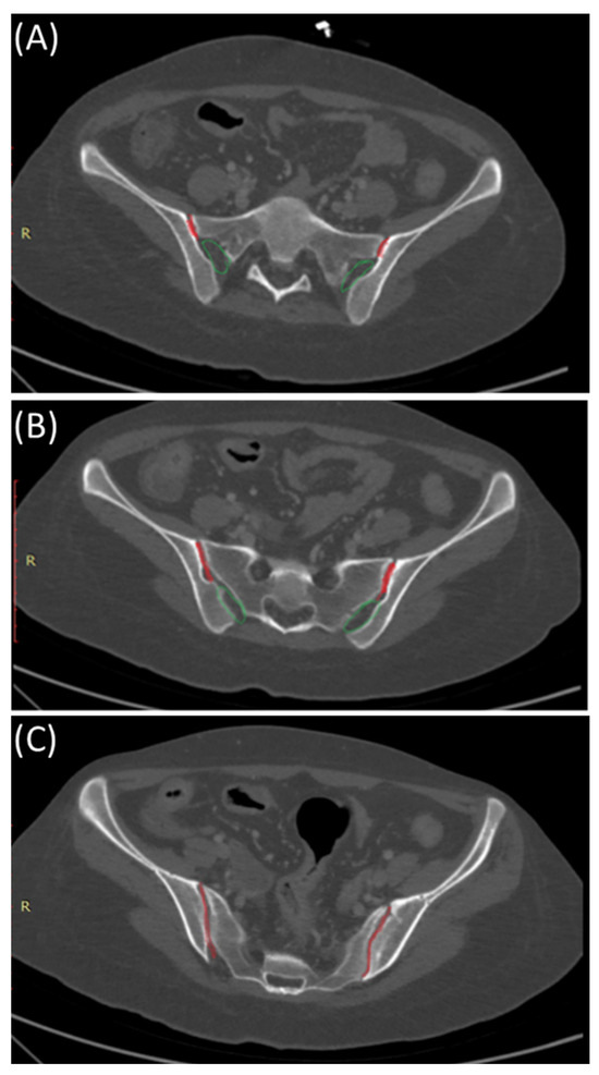 Radiological Insights into Sacroiliitis: A Narrative Review