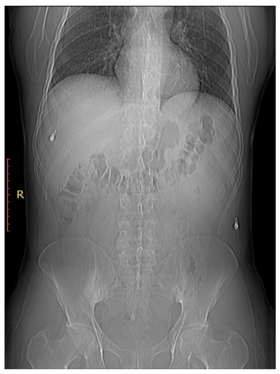 Radiological Insights into Sacroiliitis: A Narrative Review