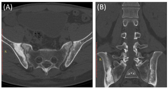 Radiological Insights into Sacroiliitis: A Narrative Review