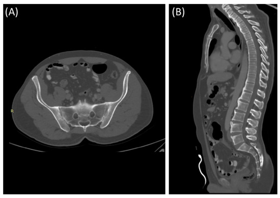 Radiological Insights into Sacroiliitis: A Narrative Review