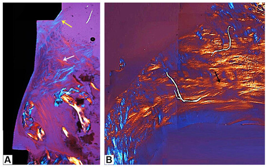 Case Report of a Dental Implant with Conometric Abutment–Prosthetic Cap ...