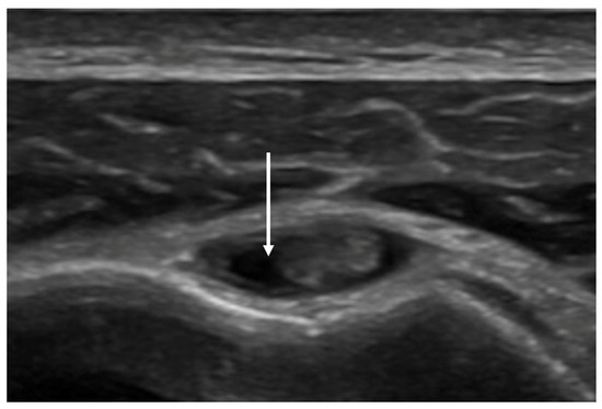 Can Secondary Adhesive Capsulitis Complicate Calcific Tendinitis of the ...