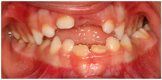 Oral Habits in Childhood and Occlusal Pathologies: A Cohort Study