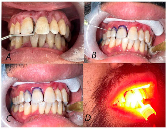 Efficacy of Non-Surgical Periodontal Therapy with Adjunctive Methylene ...