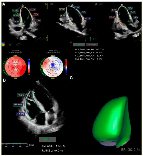 Acute Heart Failure in a Young Patient Treated in ICU—Diagnostic Pitfalls