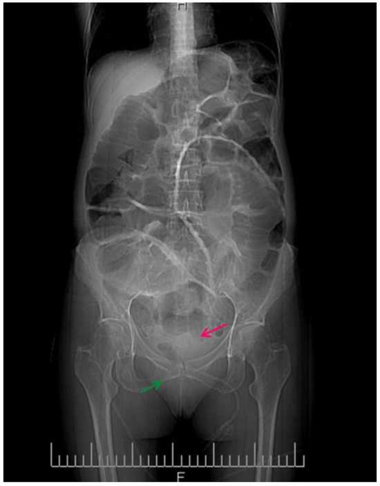 Twisted Troubles: A Rare Case of Intestinal Obstruction Due to ...