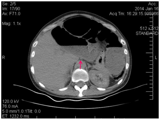 Twisted Troubles: A Rare Case of Intestinal Obstruction Due to ...