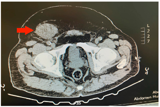 An Unusual Cause of Inguinal Mass in a Patient with Urolithiasis: A ...