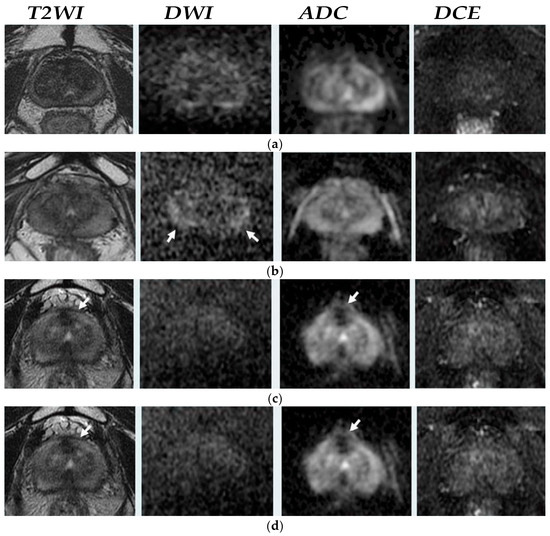 Magnetic Resonance Imaging Techniques for Post-Treatment Evaluation ...