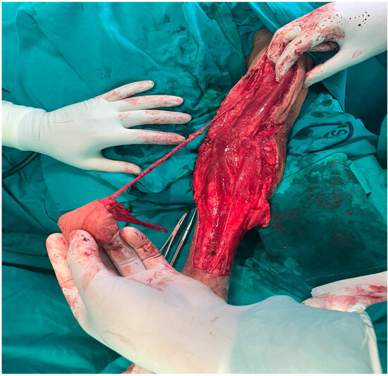 Pedicled Radial Forearm “Free” Flap for Intraoral Reconstruction Based ...