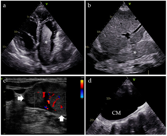 The Relevance of the Virchow Node and Virchow Triad in Renal Cancer Diagnosis