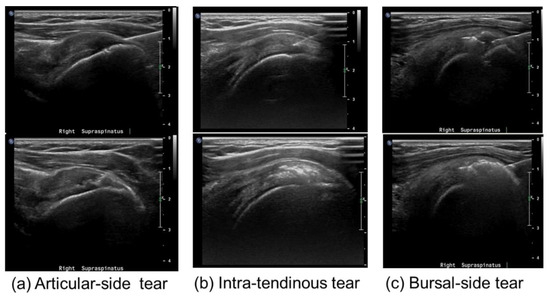 Collagen Injections for Rotator Cuff Diseases: A Systematic Review
