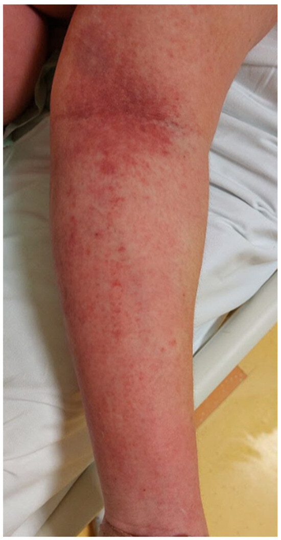 Streptococcal Toxic Shock Syndrome: Diagnostic and Therapeutic ...