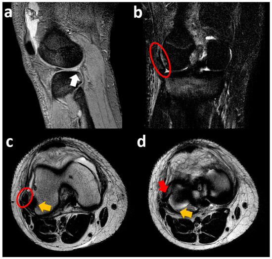 Atypically Displaced Meniscal Tears: An Educational Review with Focus ...