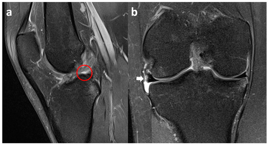 Atypically Displaced Meniscal Tears: An Educational Review with Focus ...