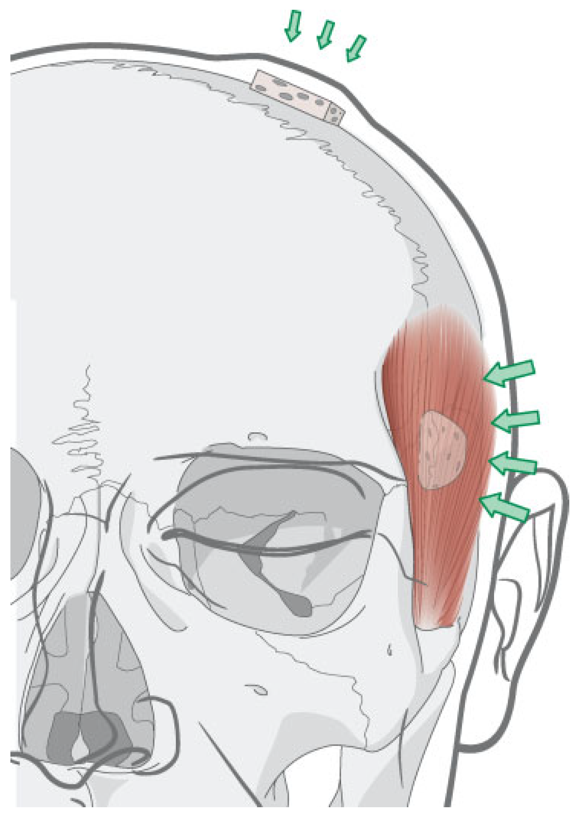 Craniofacial Bone Grafting: Wolff's Law Revisited