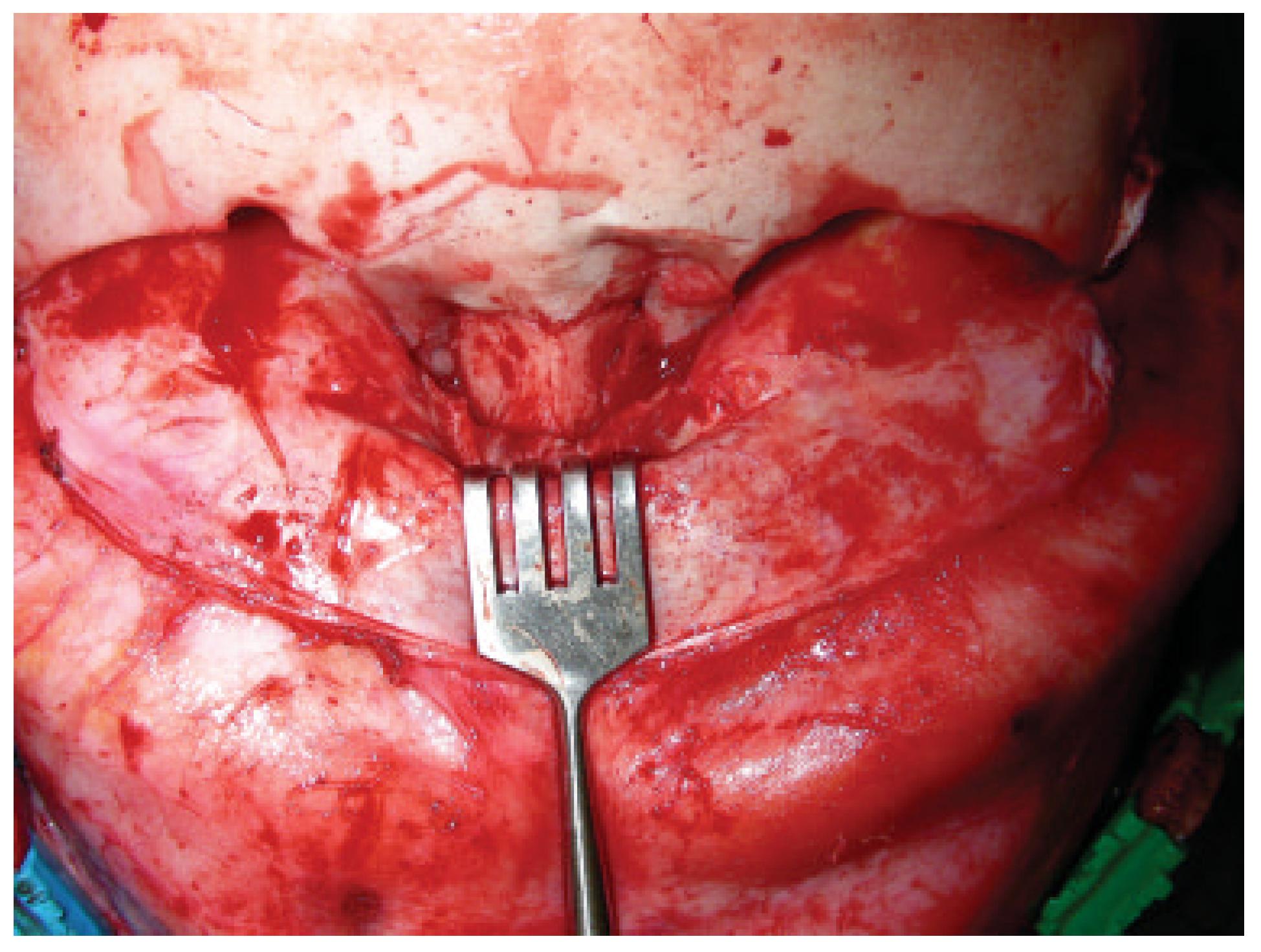 Choice of Internal Rigid Fixation Materials in the Treatment of Facial ...