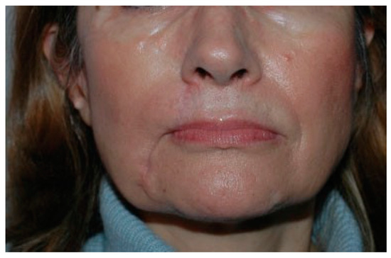 Chin IX: Unusual Soft Tissue Problems of the Lower Face