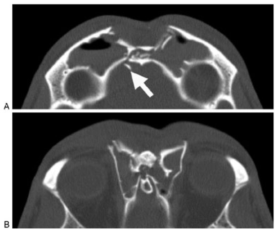Frontal Sinus Fractures: Current Concepts