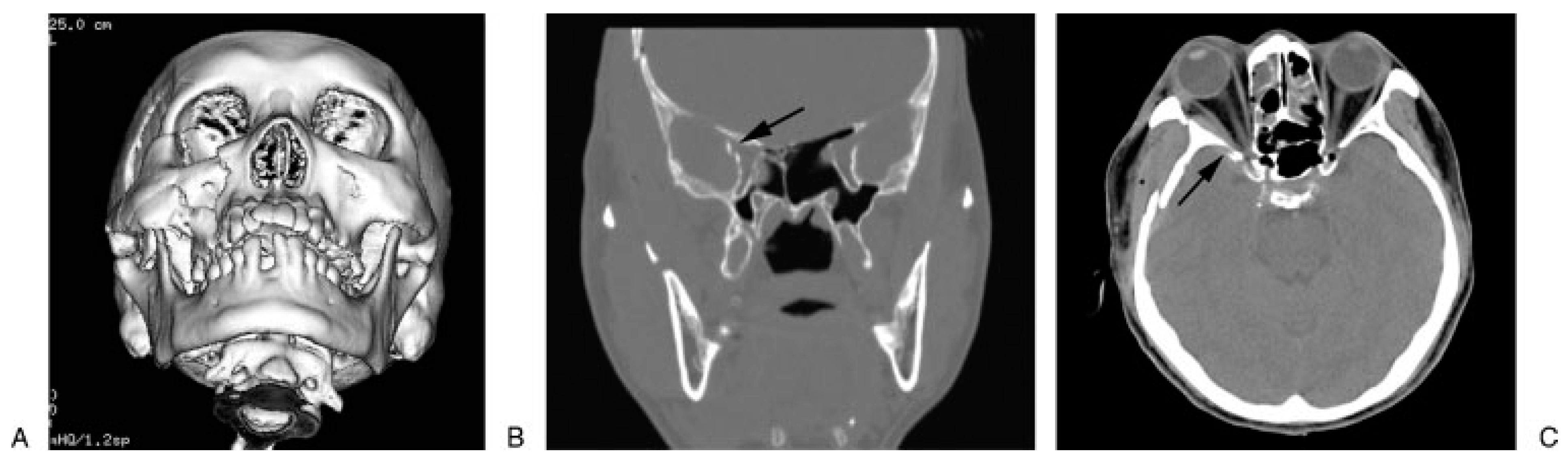 Traumatic Superior Orbital Fissure Syndrome: Current Management