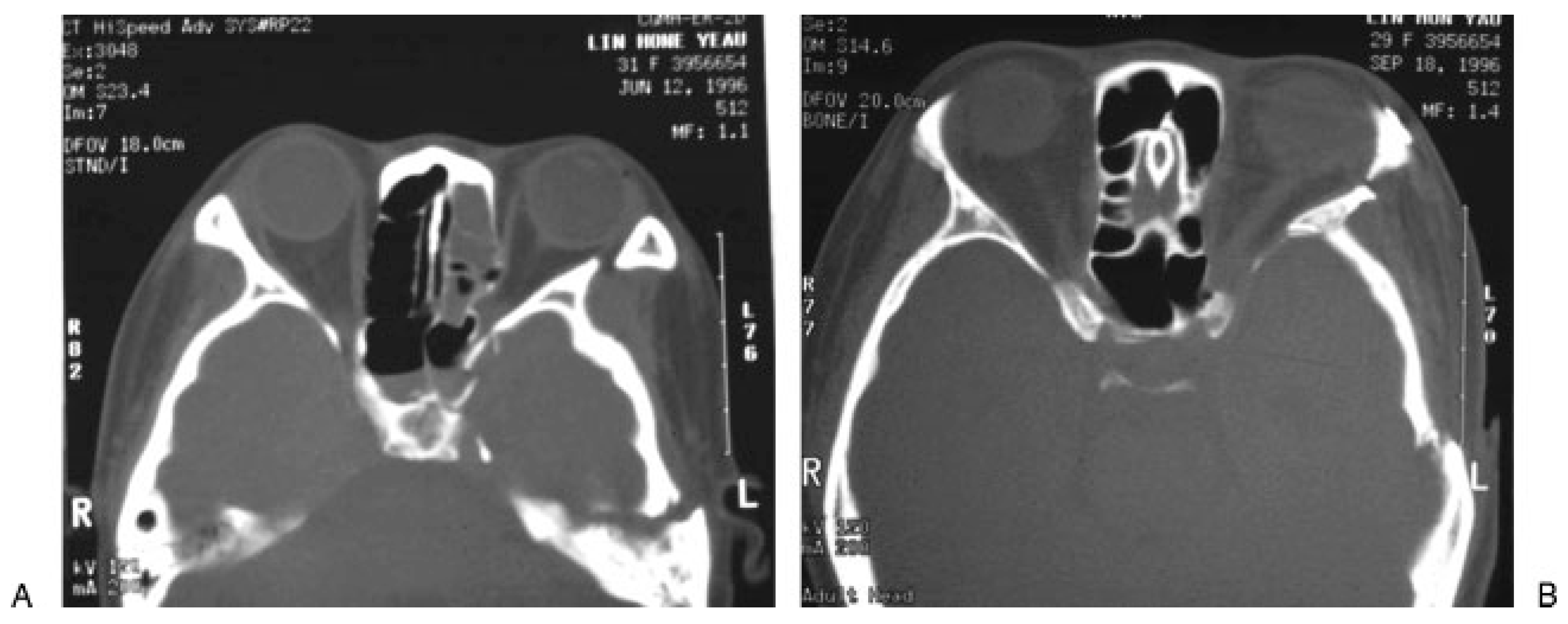 Traumatic Superior Orbital Fissure Syndrome: Current Management