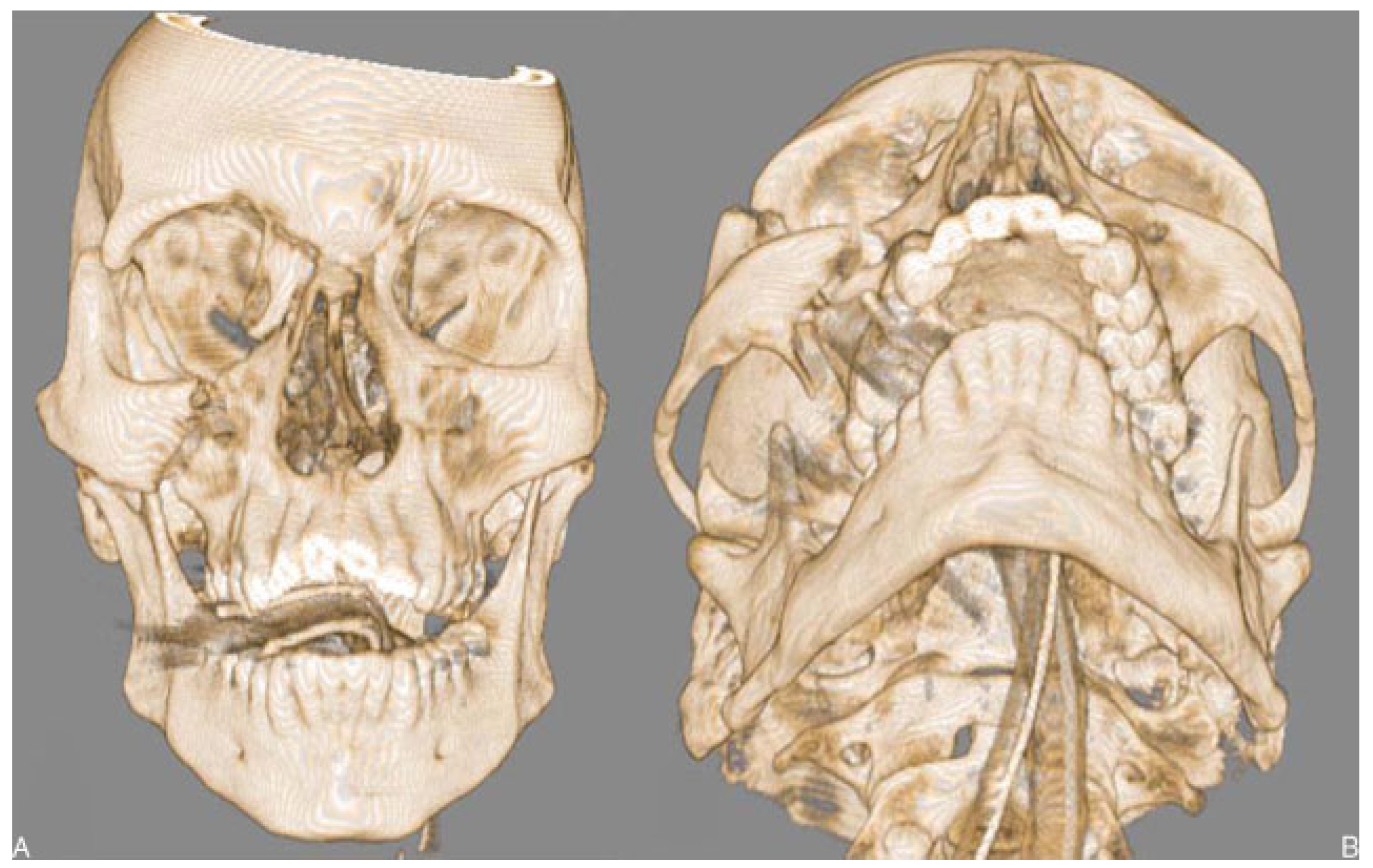Three-Dimensional Analysis of Zygomatic-Maxillary Complex Fracture Patterns