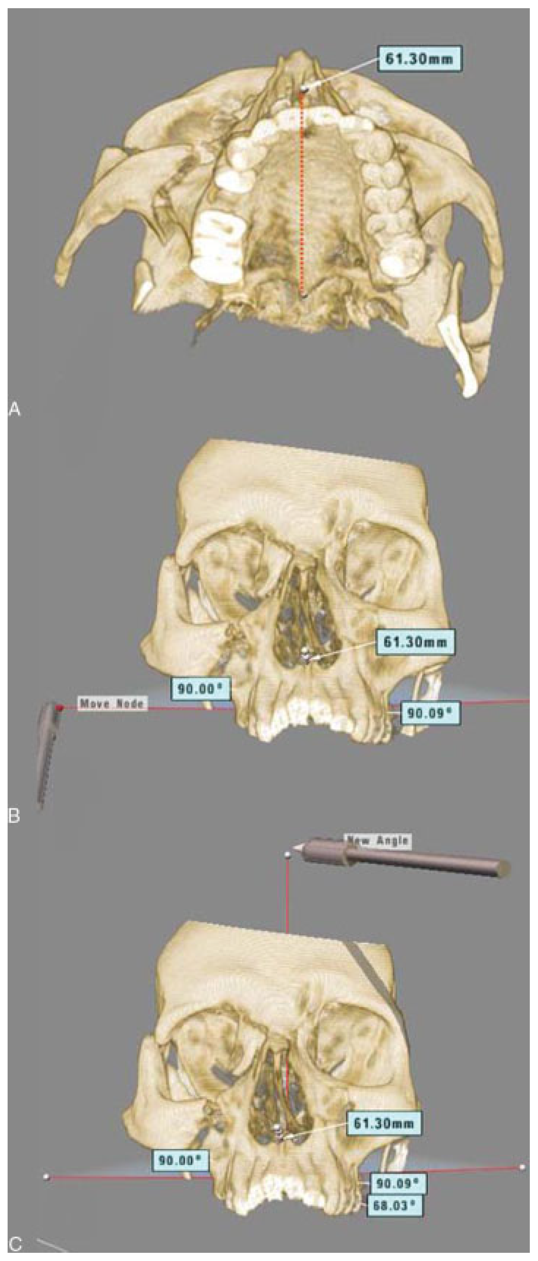 Three-Dimensional Analysis of Zygomatic-Maxillary Complex Fracture Patterns
