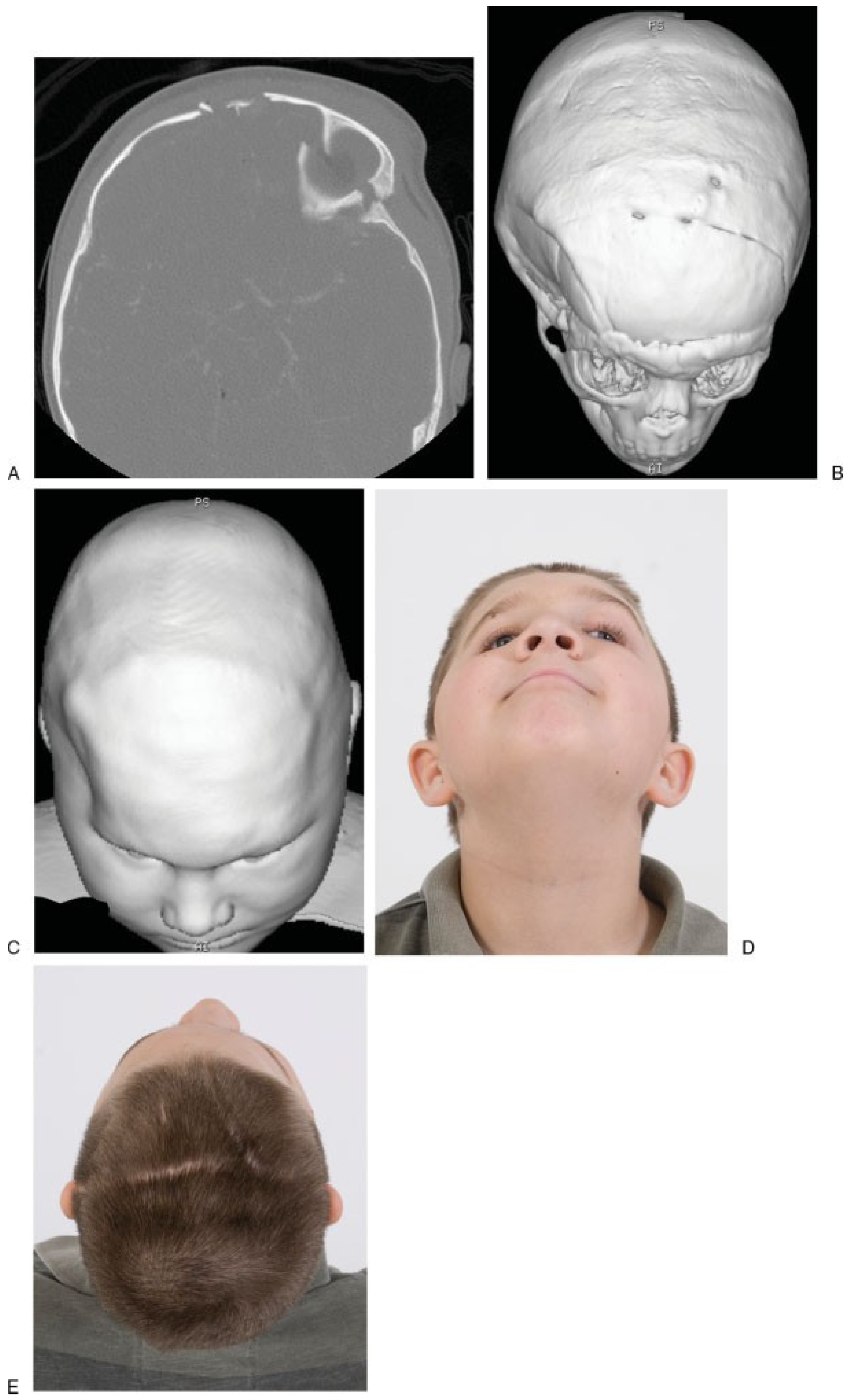 Pediatric Facial Fractures and Potential Long-Term Growth Disturbances