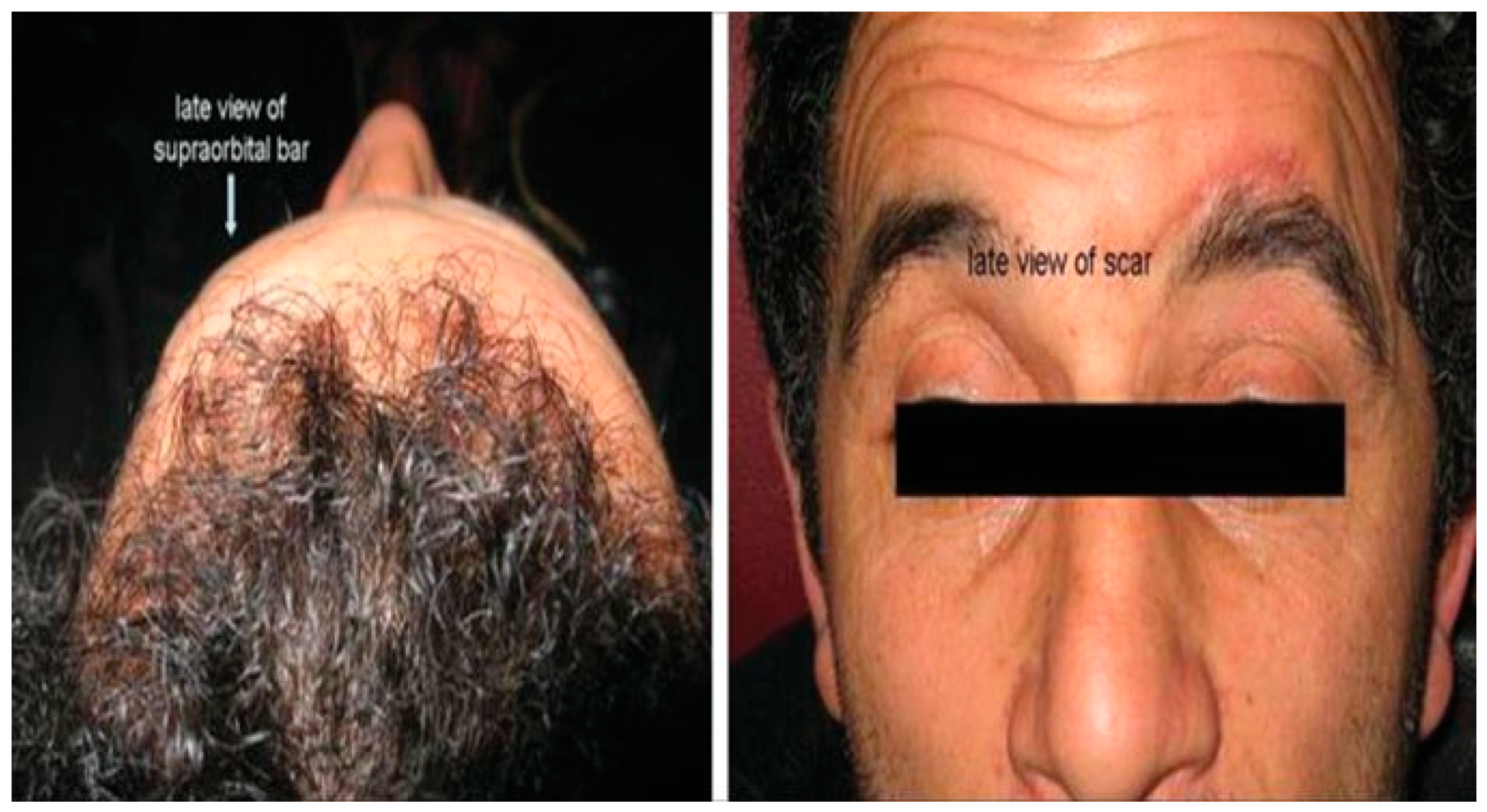 Supraorbital Rim Contour Restoration with Porous Polyethylene Implant ...