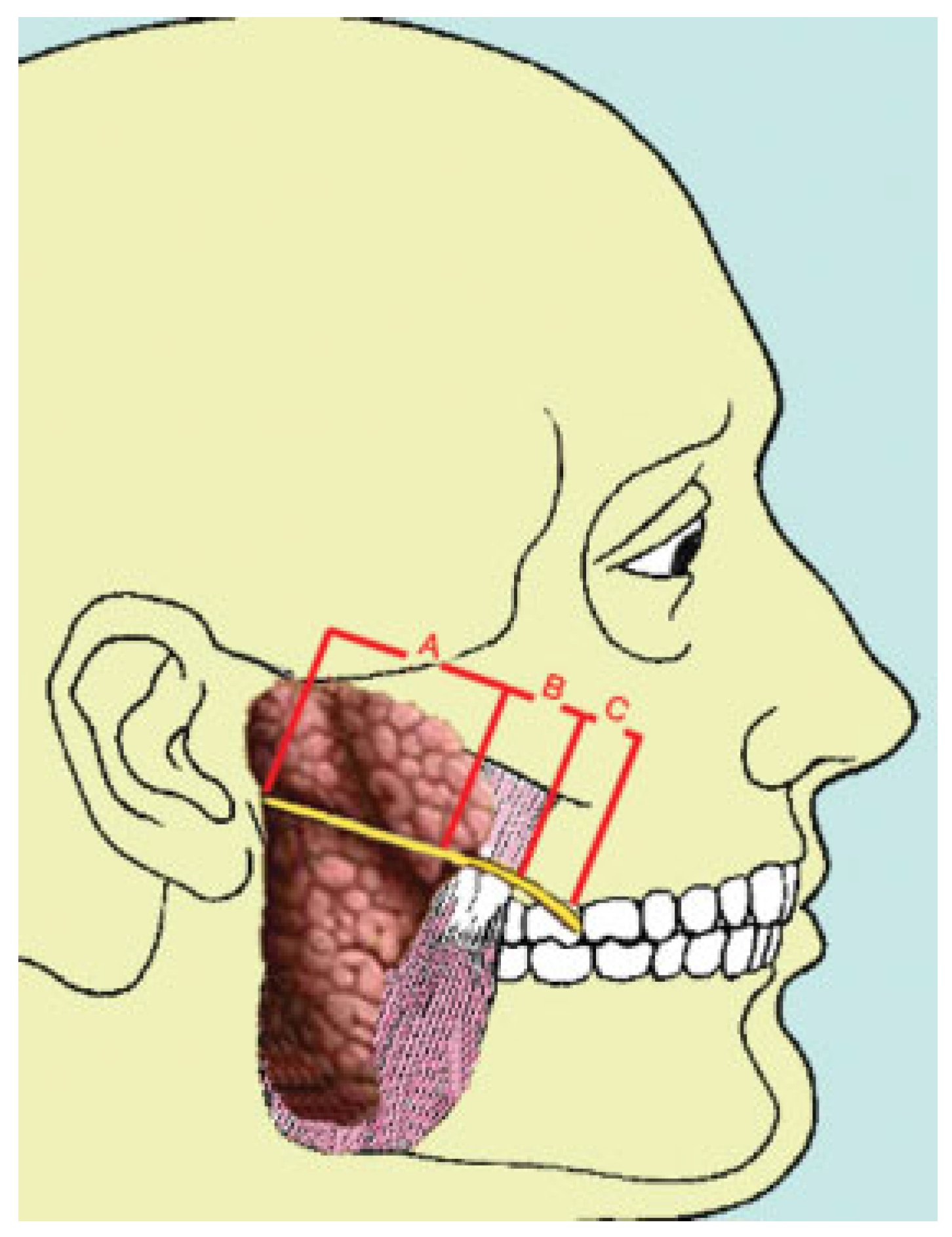 Salivary Gland Trauma: A Review of Diagnosis and Treatment