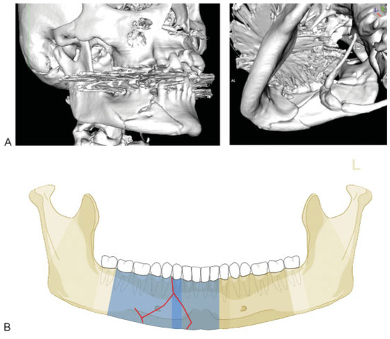 The Comprehensive AOCMF Classification System: Mandible Fractures—Level ...