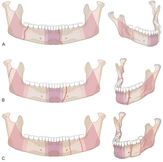 The Comprehensive AOCMF Classification System: Mandible Fractures—Level ...