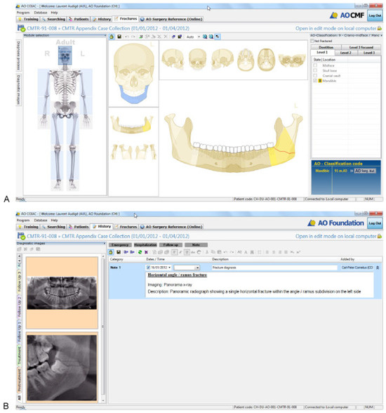 The Comprehensive AOCMF Classification System: Classification and ...