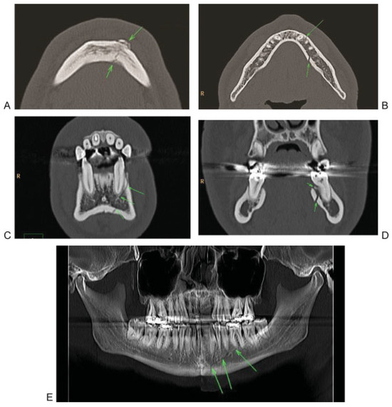 The Comprehensive AOCMF Classification System: Radiological Issues and ...
