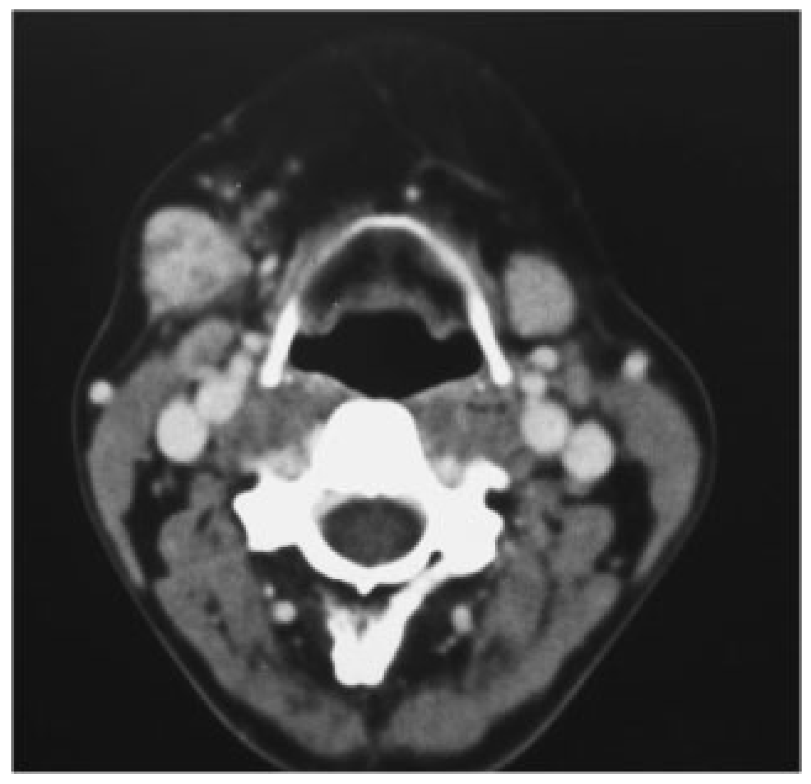 Remarkable Triple Pleomorphic Adenoma Affecting Both Parotid and ...