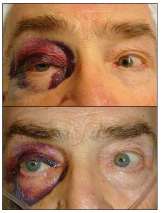 Superior Orbital Fissure Syndrome in Lateral Orbital Wall Fracture ...