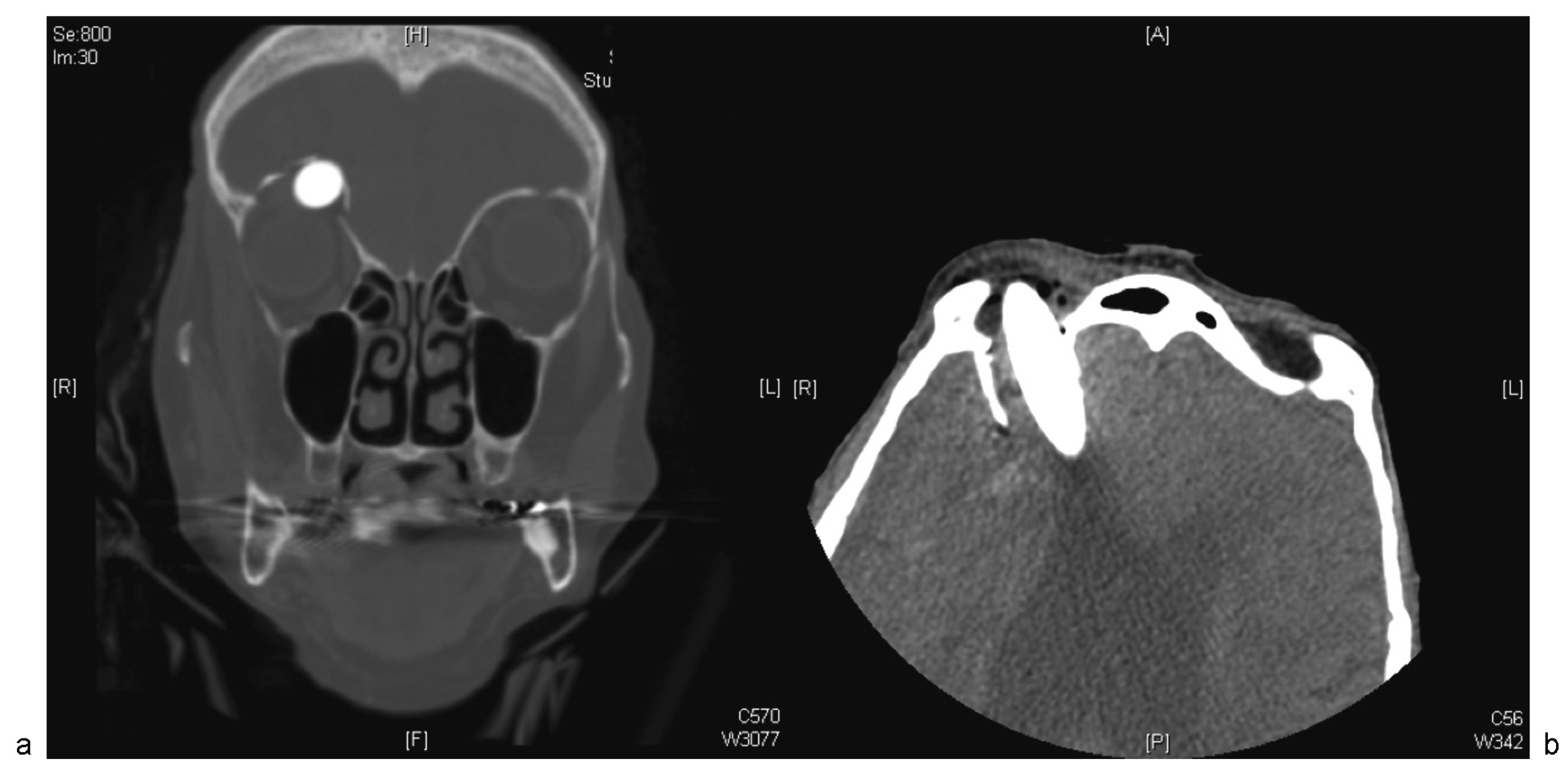 Orbitocerebral Impalement: Case Discussion and Management Algorithm