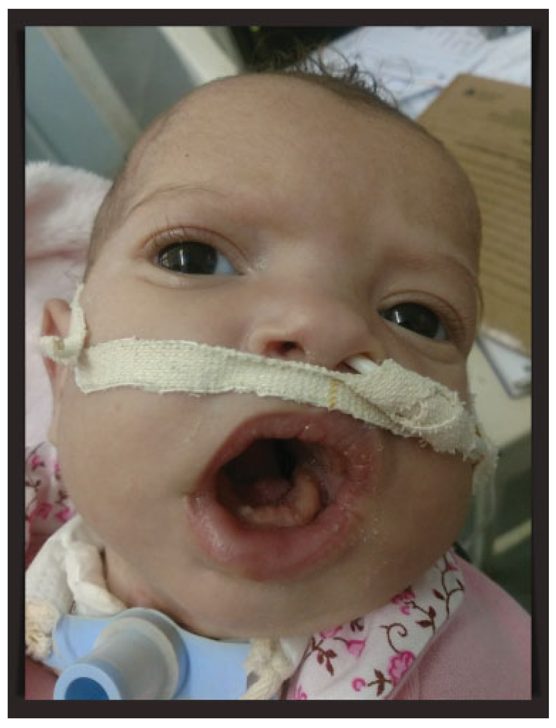 Oral Epignathus with Maxilla Duplication: Report of a Rare Case