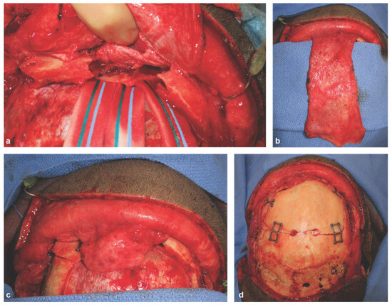 Frontal Sinus Fractures: Management and Complications