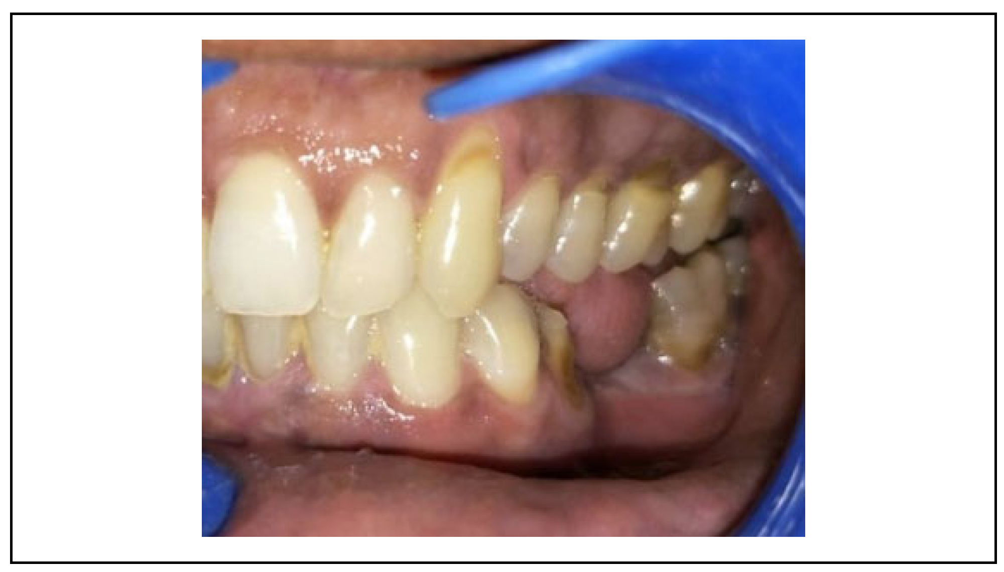 The Use of a Novel CAD-CAM Splint to Simplify Open Reduction and ...