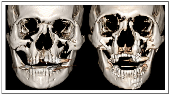 Management of Le Fort I Fractures