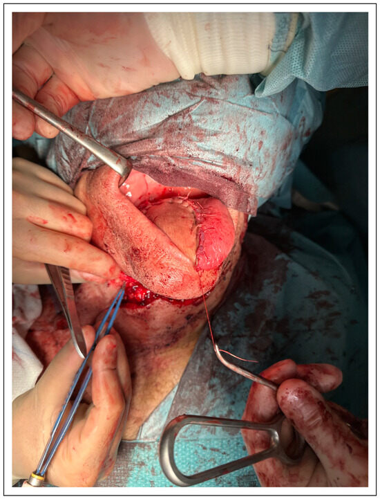 The Versatility of the Supraclavicular Flap for Head and Neck ...