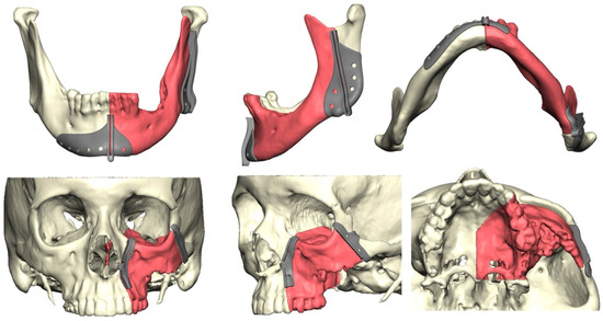 Oncological Outcomes Following Computer Aided Reconstructive Jaw Surgery