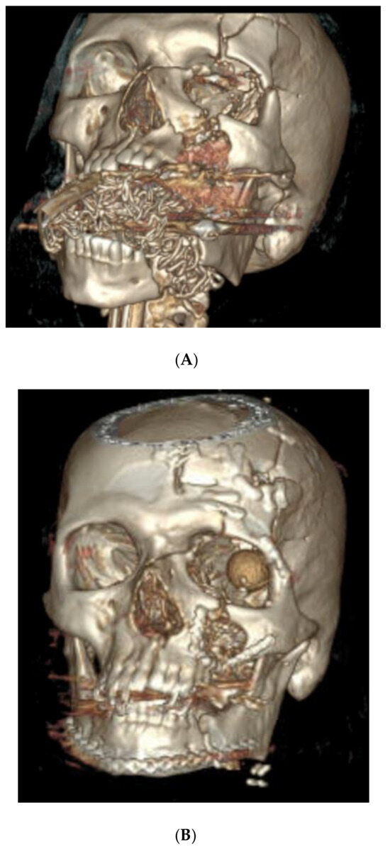 Virtual Surgical Planning for Management of Acute Maxillofacial Trauma