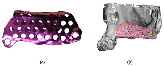 Titanium Meshes in Guided Bone Regeneration: A Systematic Review